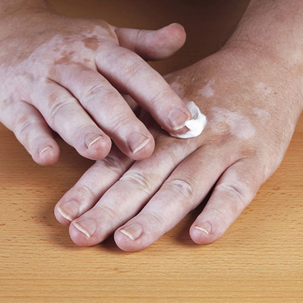 Vitiligo: when skin loses its pigmentation | Brunet